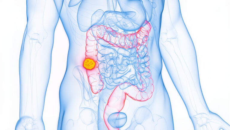 Colon ascendens: Definition, Anatomie und Klinik